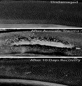 Hearing Loss: Los Angeles Ear Specialist