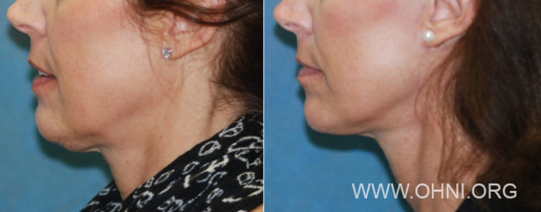The Micro-Mini Lift®: Minimally Invasive Facelift