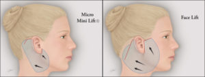 The Micro-Mini Lift®: Minimally Invasive Facelift