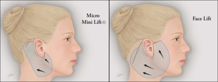 The Micro-Mini Lift®: Minimally Invasive Facelift