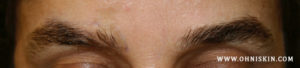 Skin Cancers Involving the Eyebrow: Clinical Considerations
