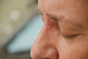 Basal Cell Carcinoma: Nasal Bridge Reconstruction - Los Angeles ENT ...