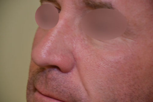 Skin Cancer Archives - Los Angeles ENT Doctors ENT Specialists Top Surgeons
