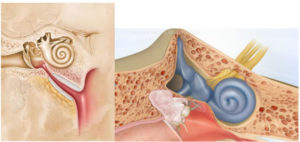 Cholesteatoma 101 - Los Angeles ENT Doctors ENT Specialists Top Surgeons