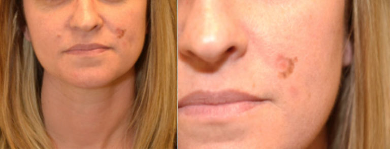 Melanoma: Overview - Los Angeles ENT Doctors ENT Specialists Top Surgeons Melanoma: Overview - Los Angeles ENT Doctors ENT Specialists Top Surgeons